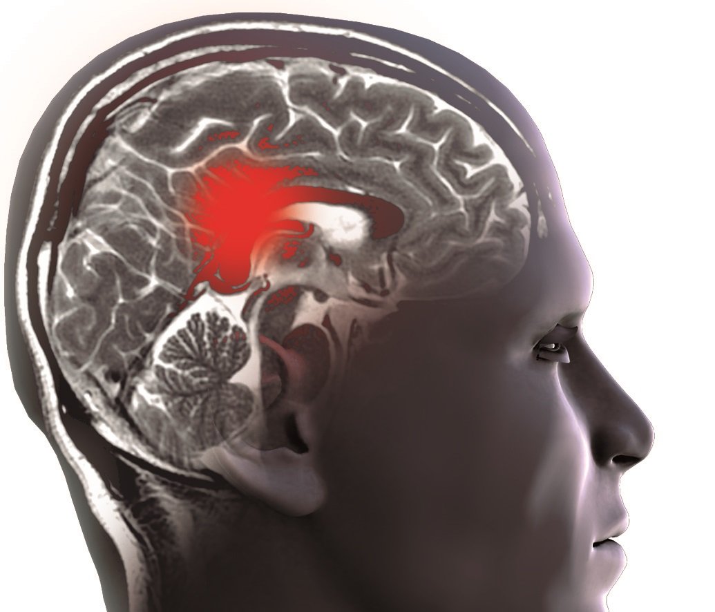 Aprenda a reconhecer os sintomas do AVC - Aprenda a reconhecer os ...